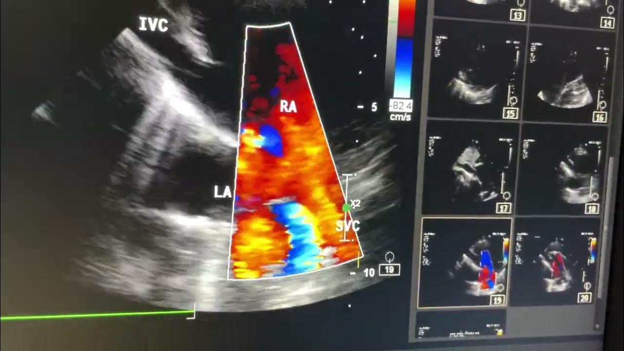 Sinus Venosus Asd Svc Partial Anomalous Pulmonary Venosus Connection Youtube