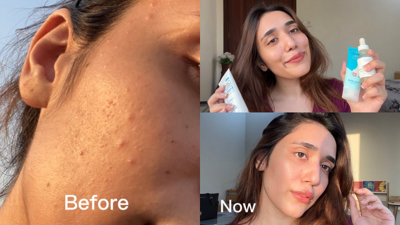 How To Really Get Rid Of Acne Texture Closed Comedones