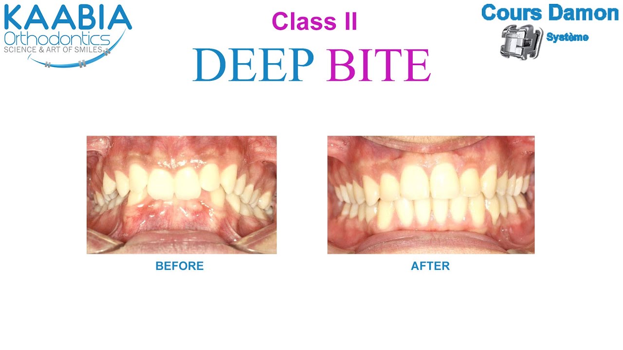Class 2 div2 , Severe Deep Bite , Classe 2 div2 , supraclusie sévère ...