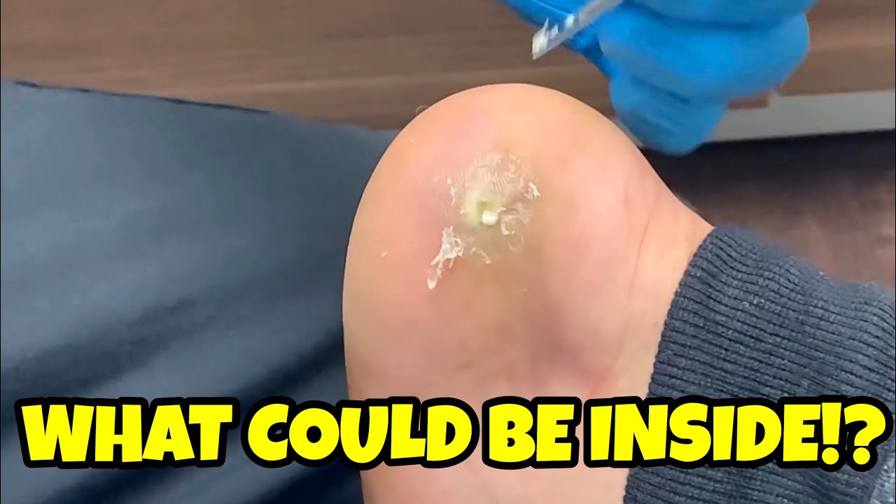 INCISION AND DRAINAGE OF A CREAMY HEEL ABSCESS WITH DEBRIDEMENT OF ...