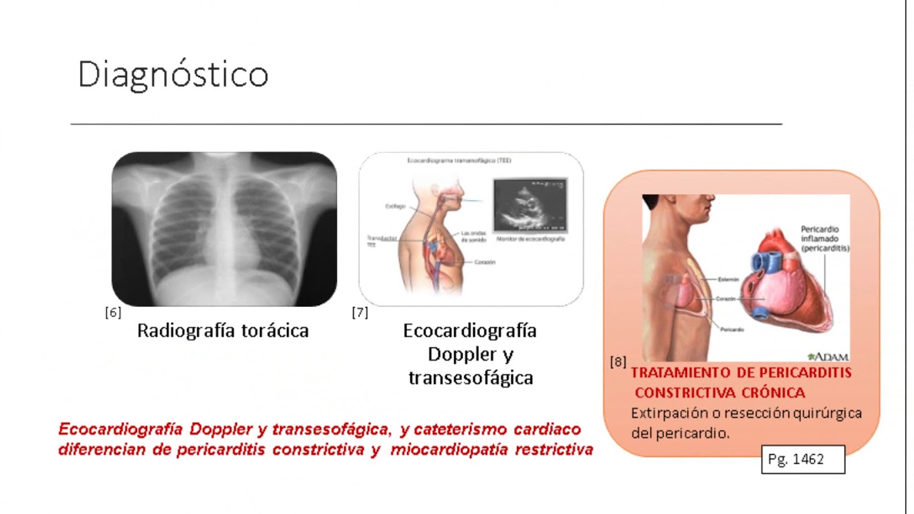 TRASTORNOS DE LA FUNCIÓN CARDÍACA (PERICARDITIS AGUDA) PARTE II - YouTube
