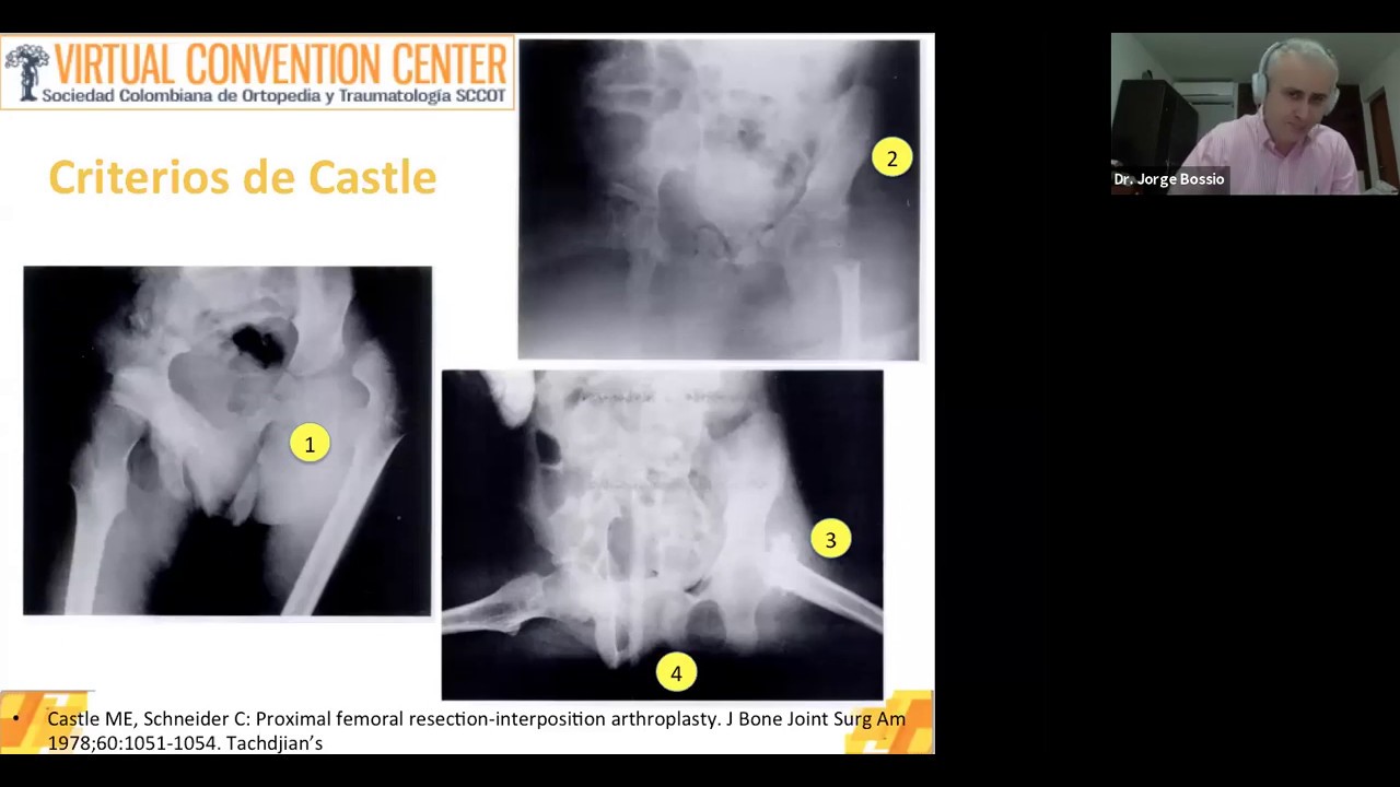 Webinar ¿Será la cirugía de castle la mejor opción de tratamiento para ...