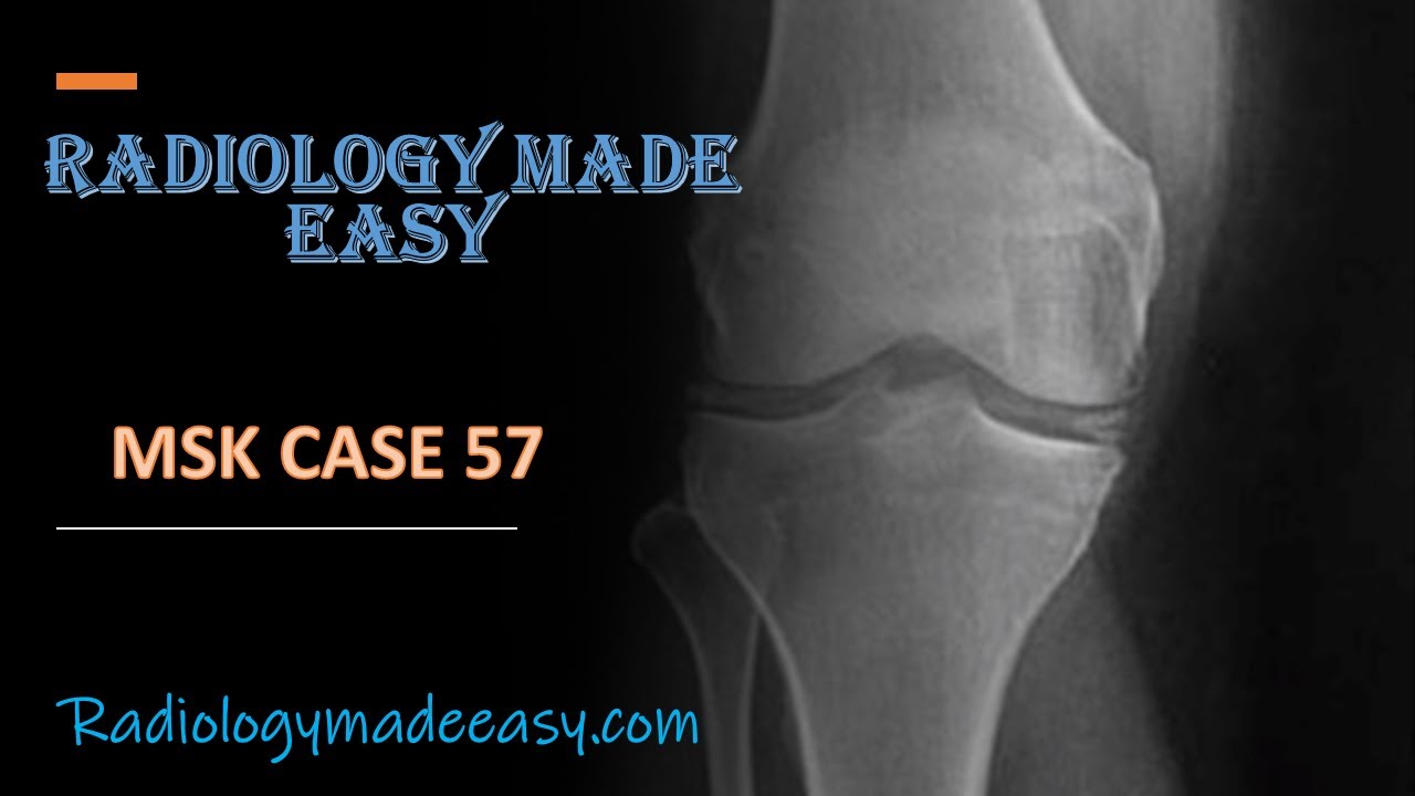 55 year old patient with pain in the left knee joint | FRCR MSK case 57 ...