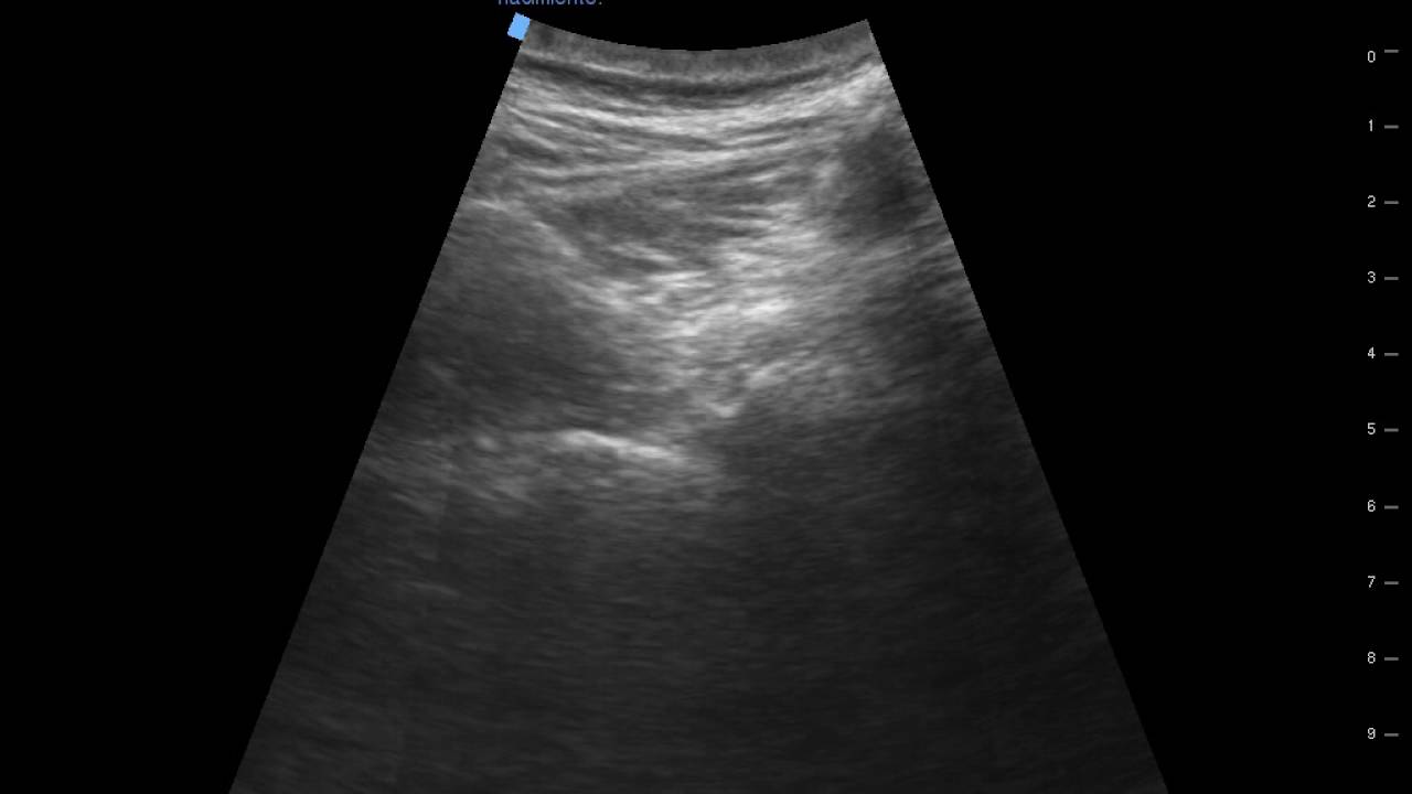 Bloqueo Radicular Lumbar Ecoguiado - YouTube