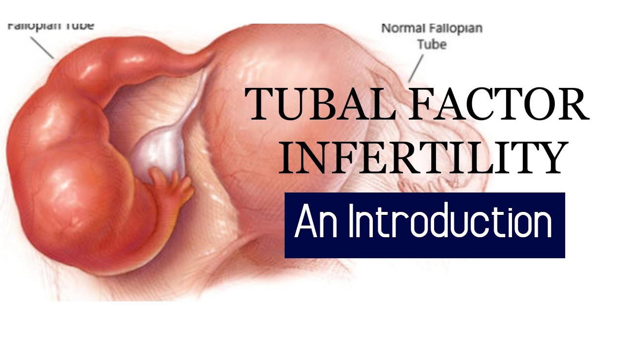Infertility: Tubal Factor Infertility & Female Fertility | Antai ...
