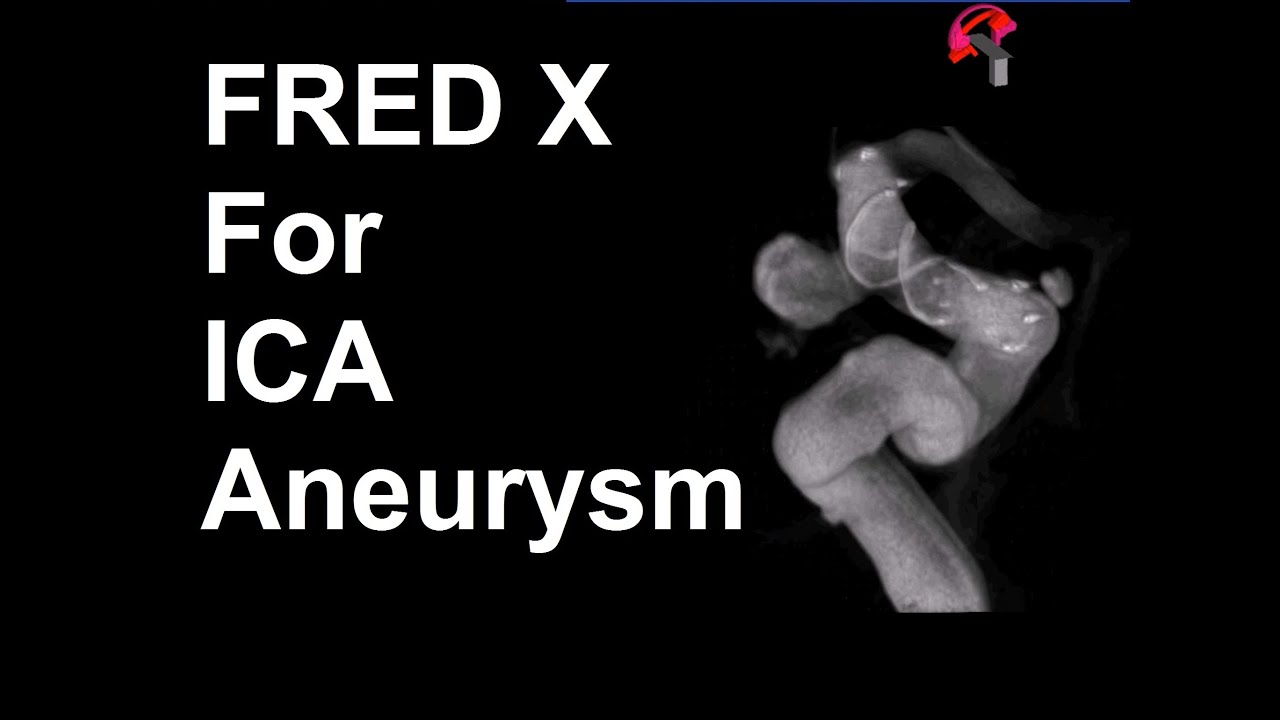 3D Image of the ICA Aneurysm Treated with Short FRED X - YouTube