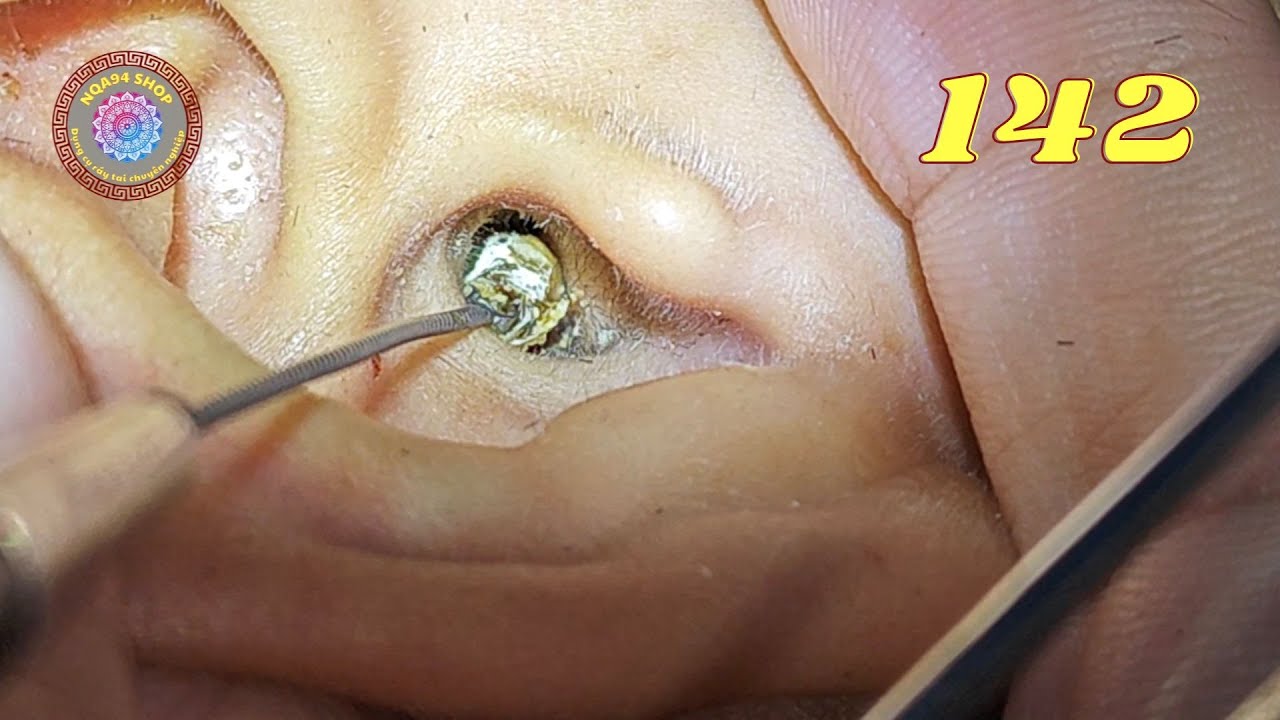 Tập 142. Lấy ráy tai không khó. Removing earwax is not difficult # ...