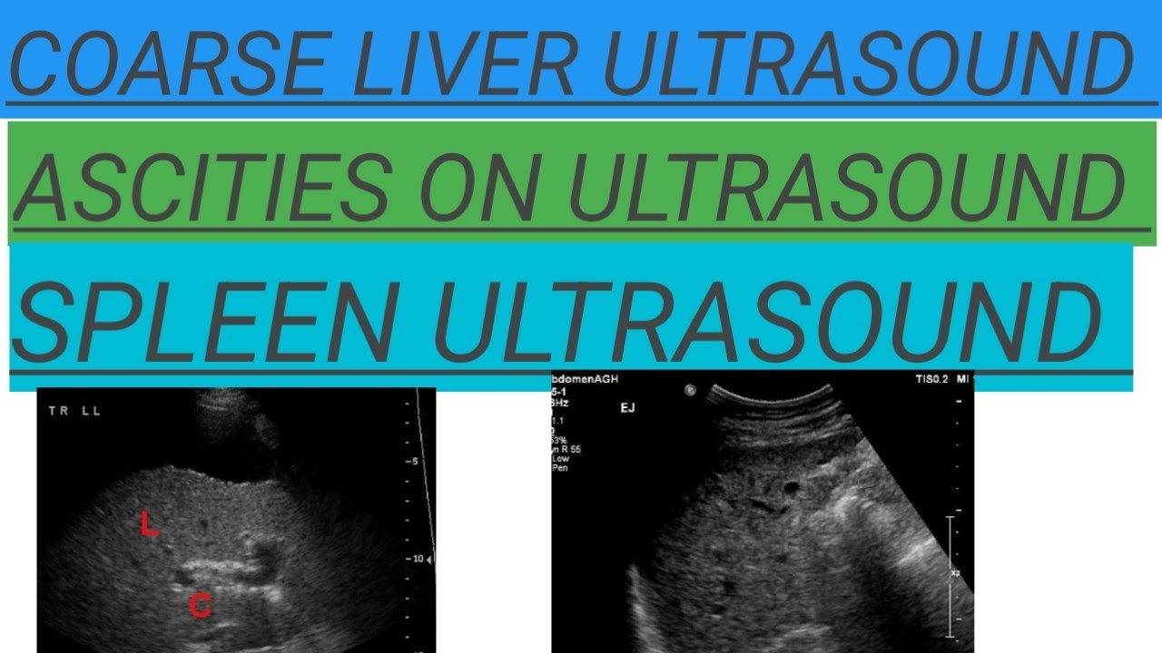 Liver ultrasound!Coarse liver parenchymal ultrasound! Ultrasound ...