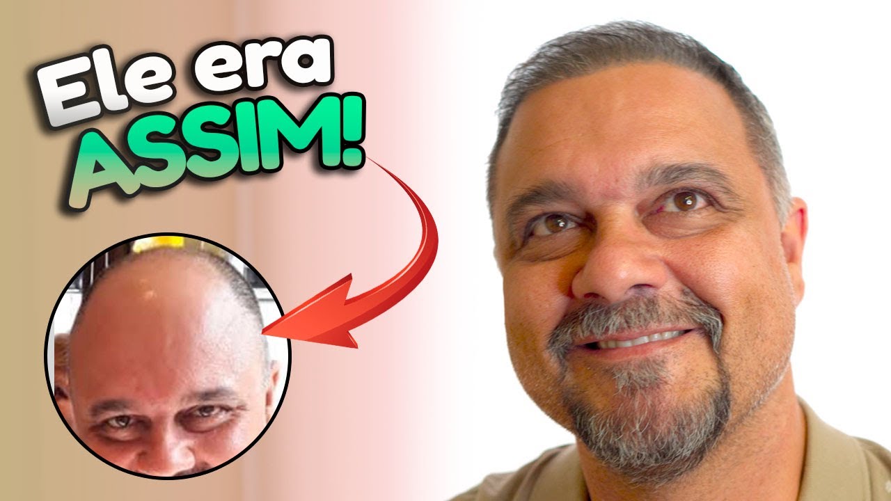 Homem calvo em 4 meses recupera 10 anos de juventude após transplante ...