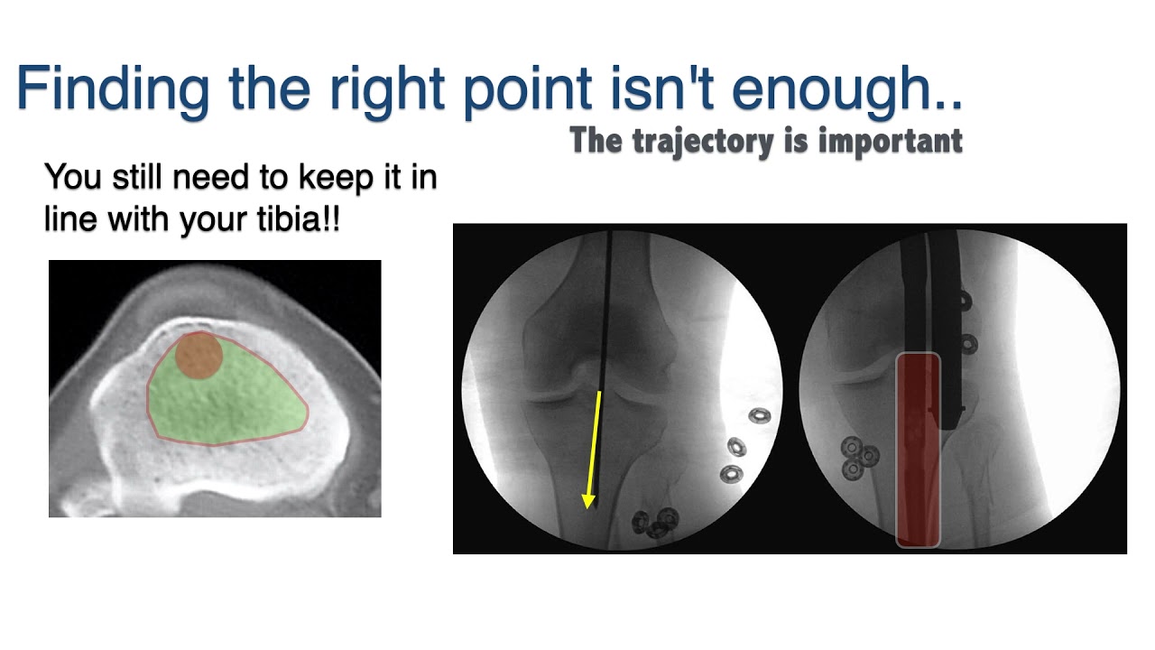Suprapatellar nailing - YouTube