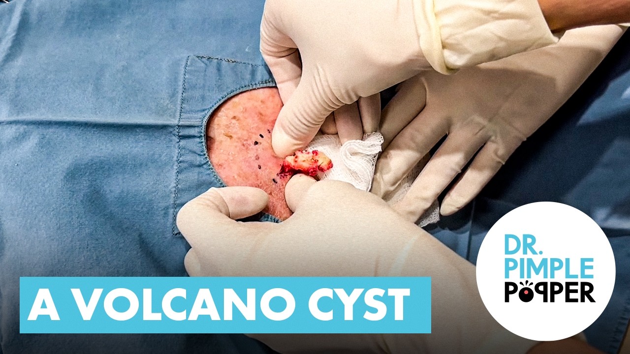 Volcano Cyst Eruption! 🌋 - YouTube