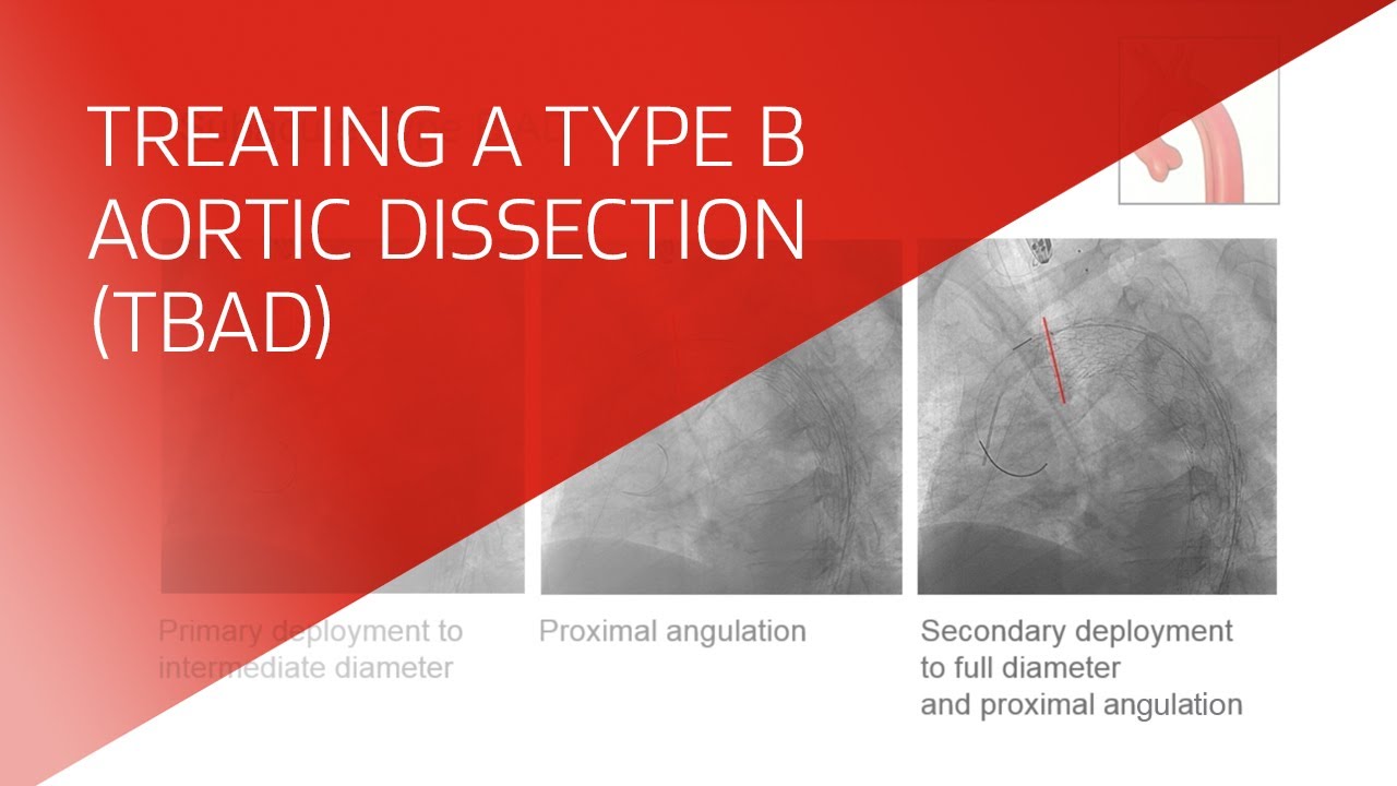 Type B aortic dissection (TBAD) case study - YouTube