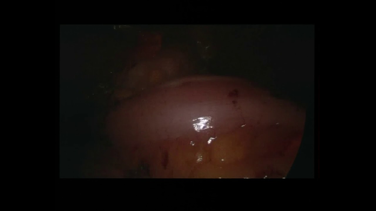 coloscopie per operatoire et resection colique segmentaire ...