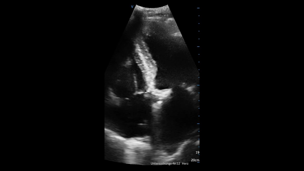 〖Echocardiography〗 A shunt from the LVOT into the RV & RA after AV ...