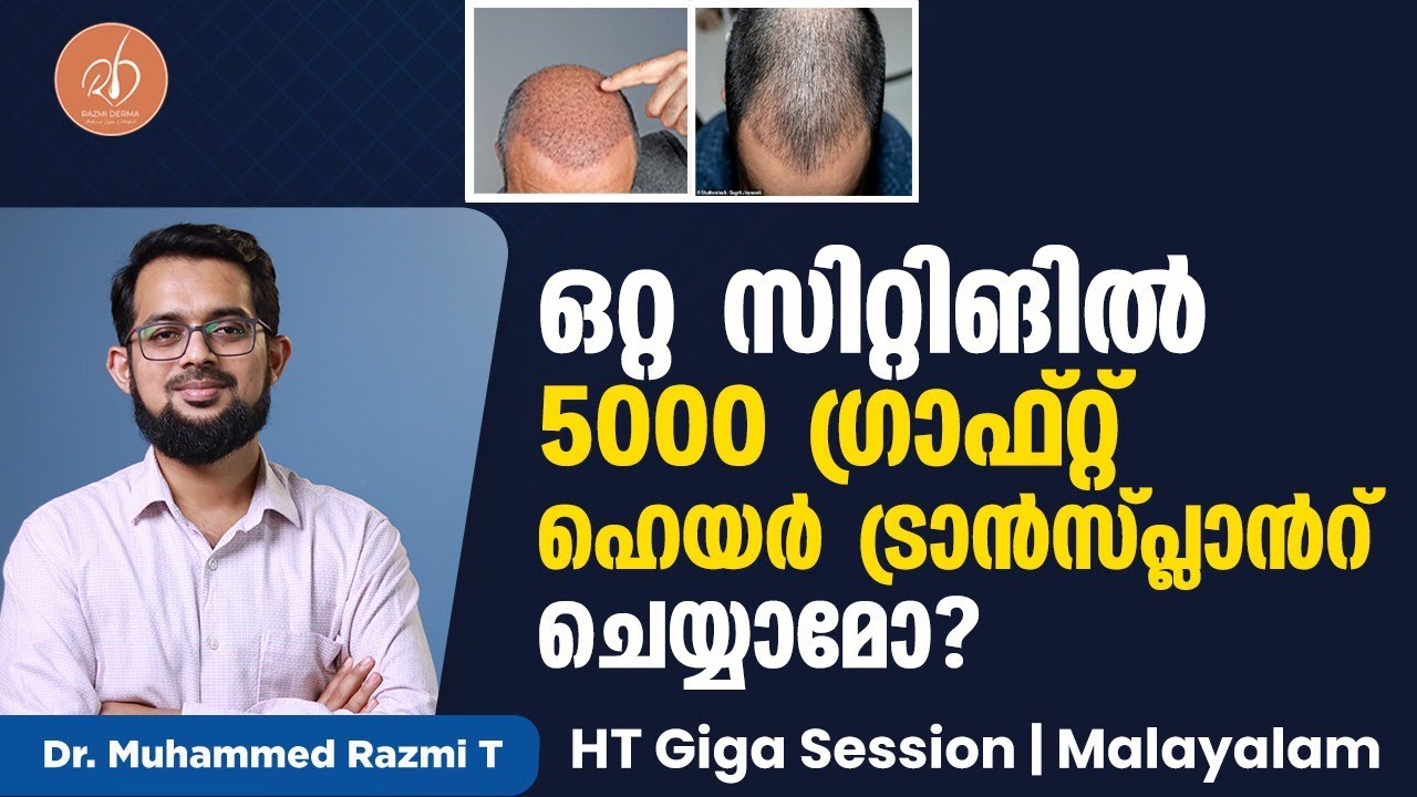 ഒറ്റ സിറ്റിങ്ങിൽ 5000 ഗ്രാഫ്റ്റ് ഹെയർ ട്രാൻസ്‌പ്ലാന്റ് ചെയ്യാമോ?HT Giga ...