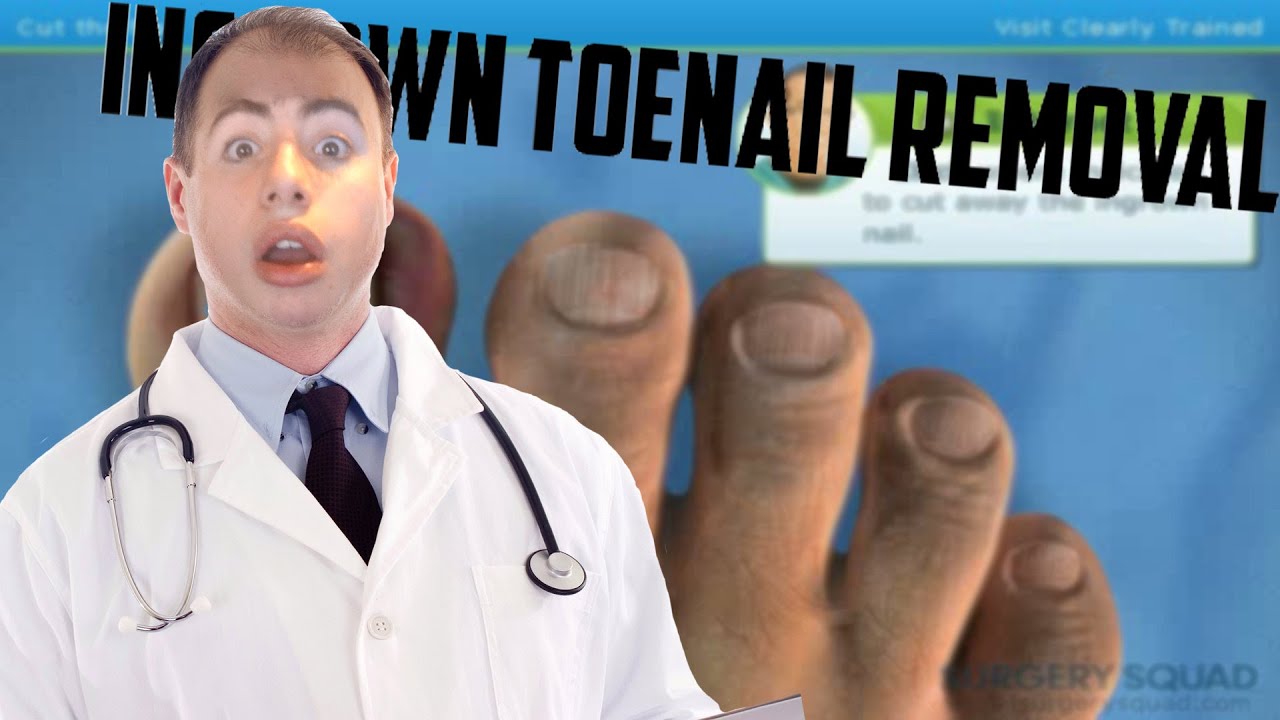 Ingrown Toenail Removal | Stop Jabbing The Mouldy Toe - YouTube