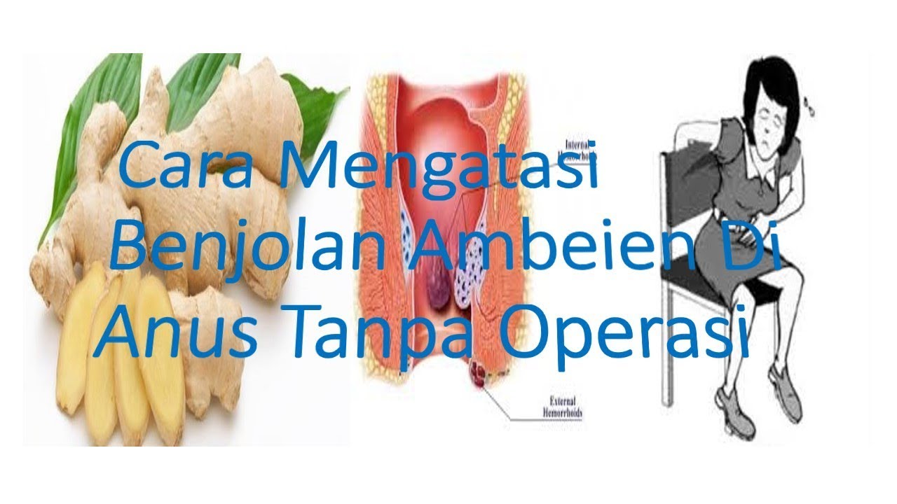 Cara Mengatasi Benjolan Ambeien Di Anus Tanpa Operasi - YouTube