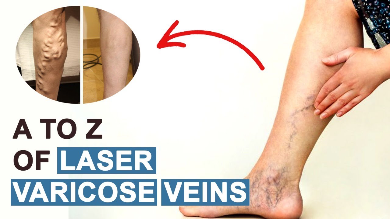 What is Laser Treatment for Varicose Veins | Atoz of Laser Varicose ...