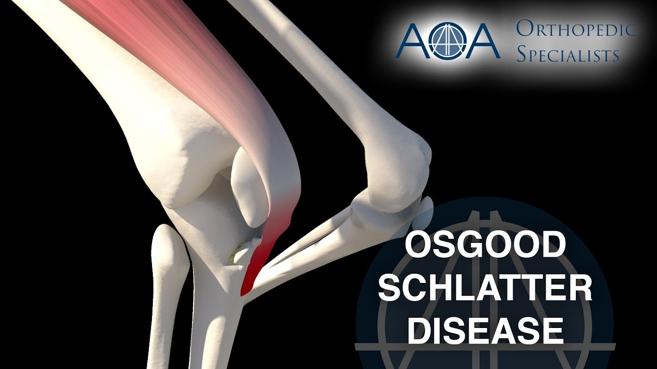 AOA Orthopedic Specialists - Osgood-Schlatter Disease - YouTube