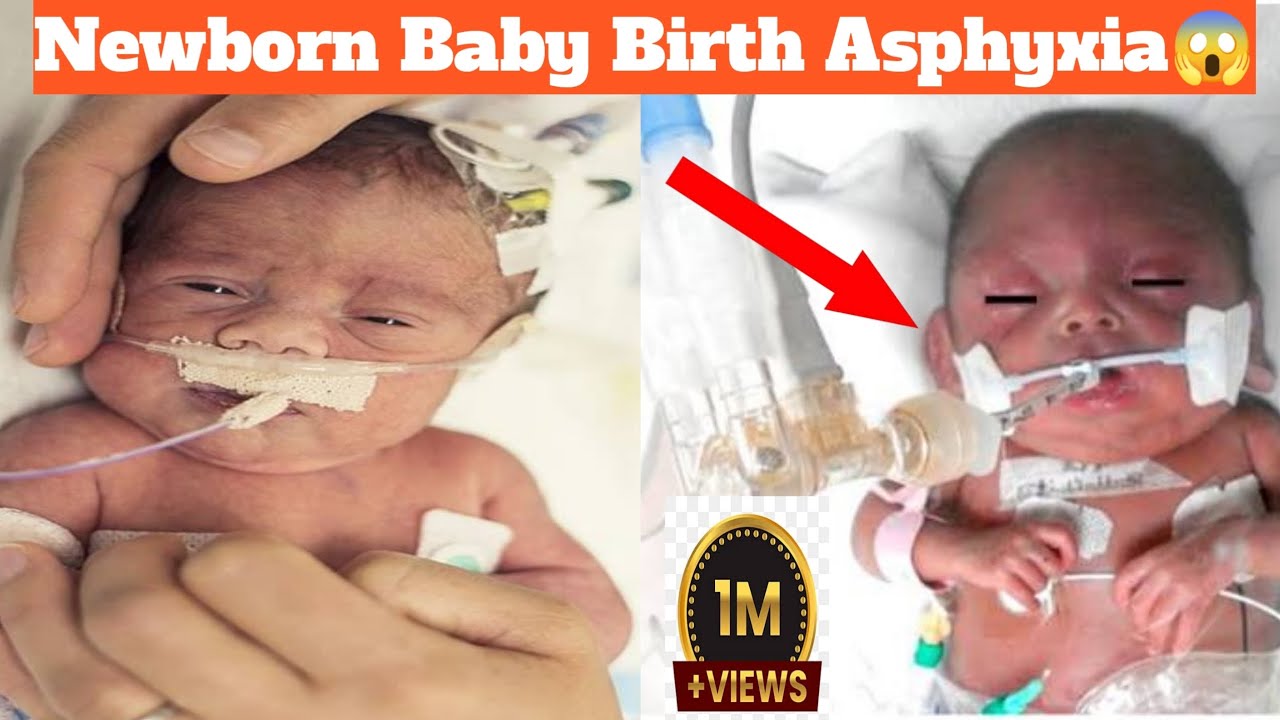 Newborn Baby Birth Asphyxia After C-Section 🥺😱#premature - YouTube