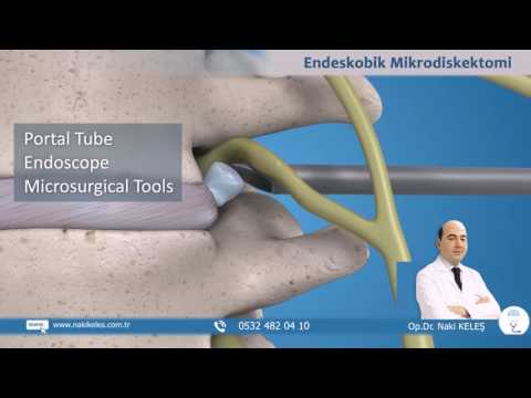 Endoscopic Lumbar Discectomy