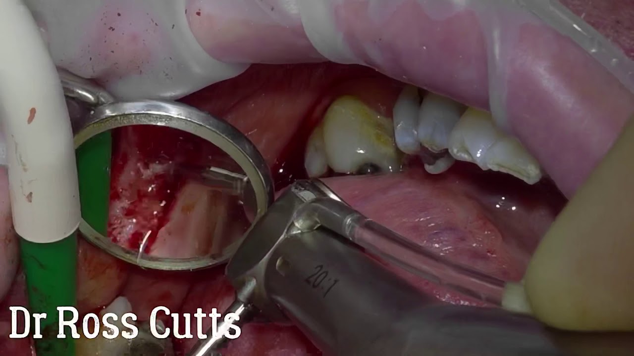 Simultaneous Straumann tissue and bone level implant placement and ...