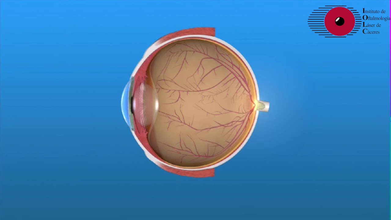 Inyección intraocular de Lucentis-Eylea-Avastin-Ozurdex en Instituto de ...
