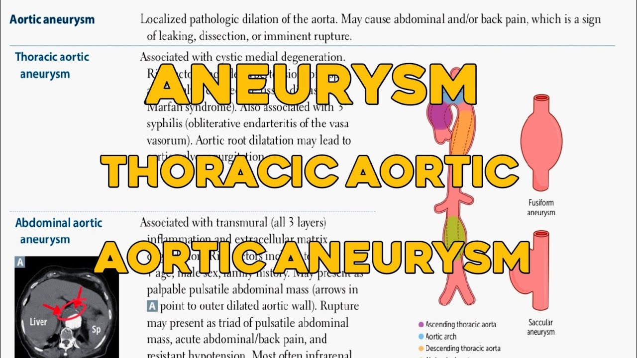 types of aneurysm || aortic aneurysm and thoracic aortic aneurysm # ...