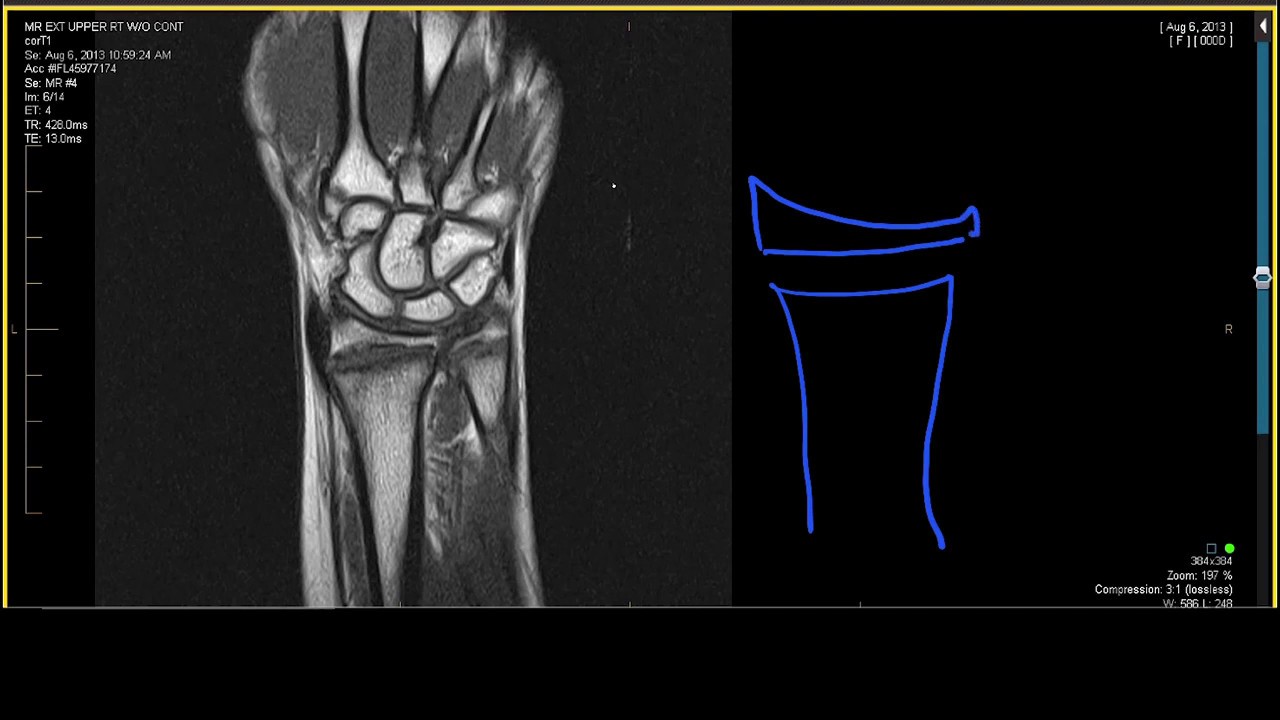 Pediatric MSK MRI Case Review - Gymnast Wrist - YouTube