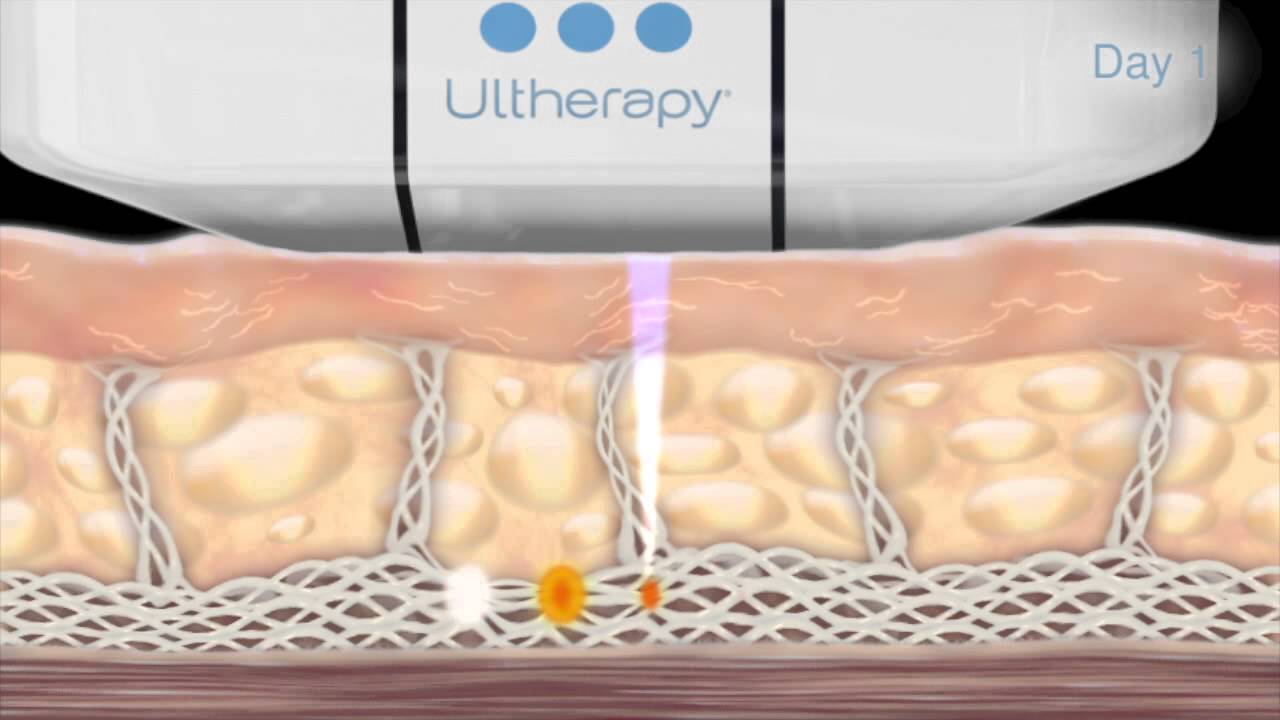 Skin tightening treatments -How does Ultherapy work - YouTube
