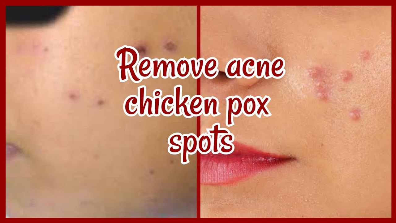 How to remove acne, chicken pox, measles spots naturally| skin ...