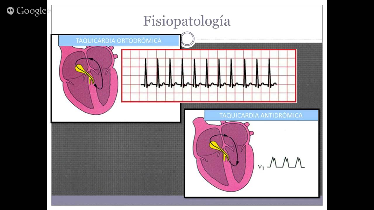 CLASE DE TAQUIARRITMIAS CON QRS ANGOSTO - YouTube