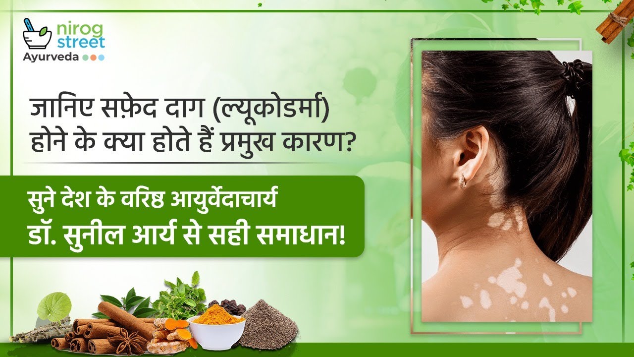 Leucoderma Symptoms, Causes and Ayurvedic Treatment - YouTube
