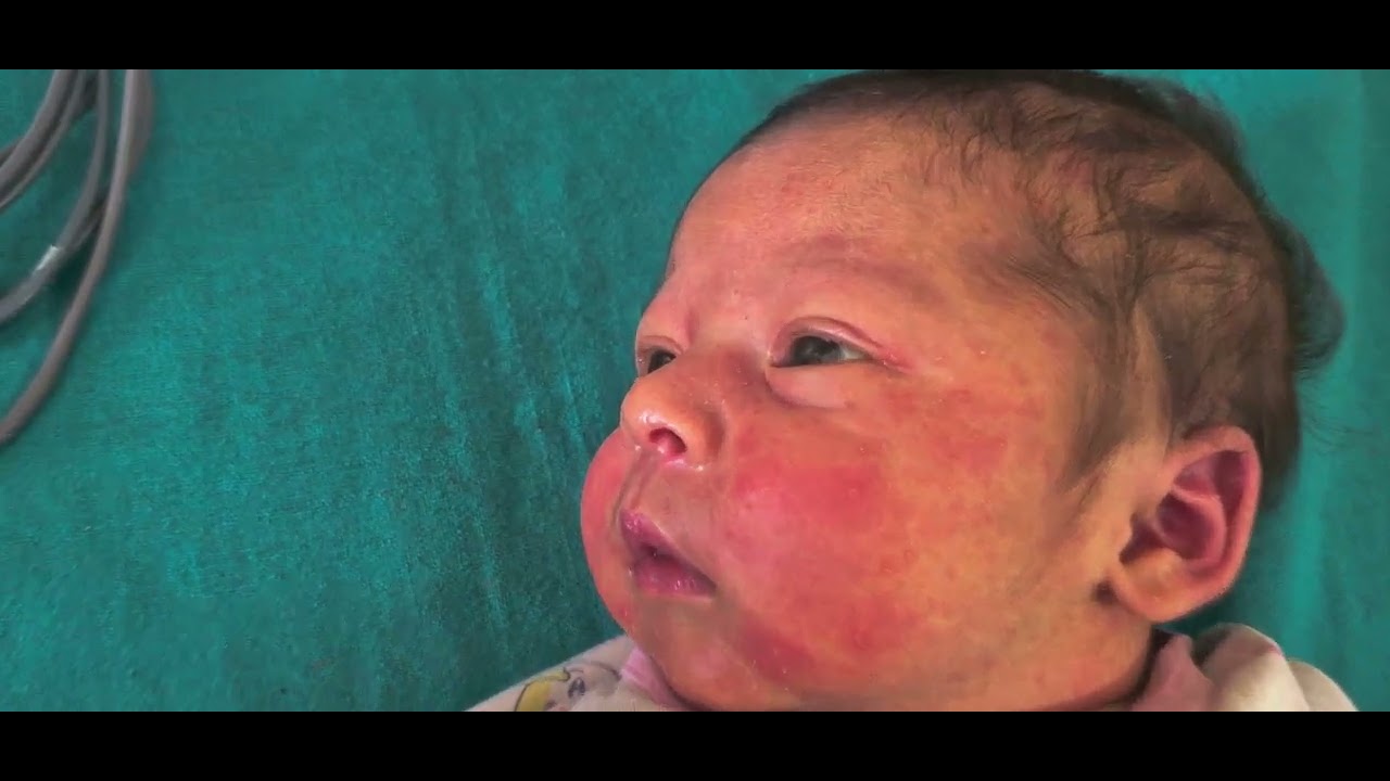 Erythema toxicum neonatorum [ ETN] # newborn REd skin #normal #no need ...