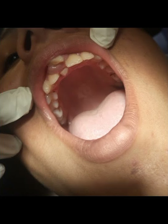 Extraction of supernumerary tooth - YouTube