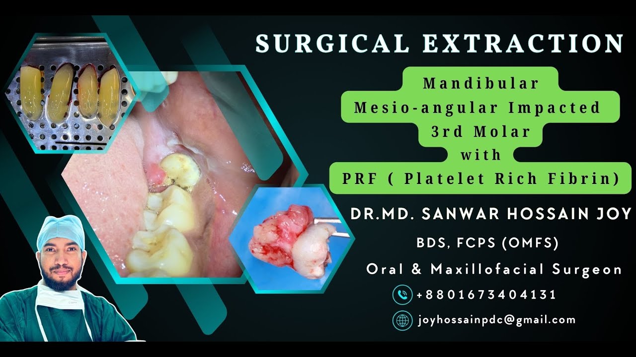 Surgical Extraction Of Mesioangular Impacted 3rd Molar - YouTube