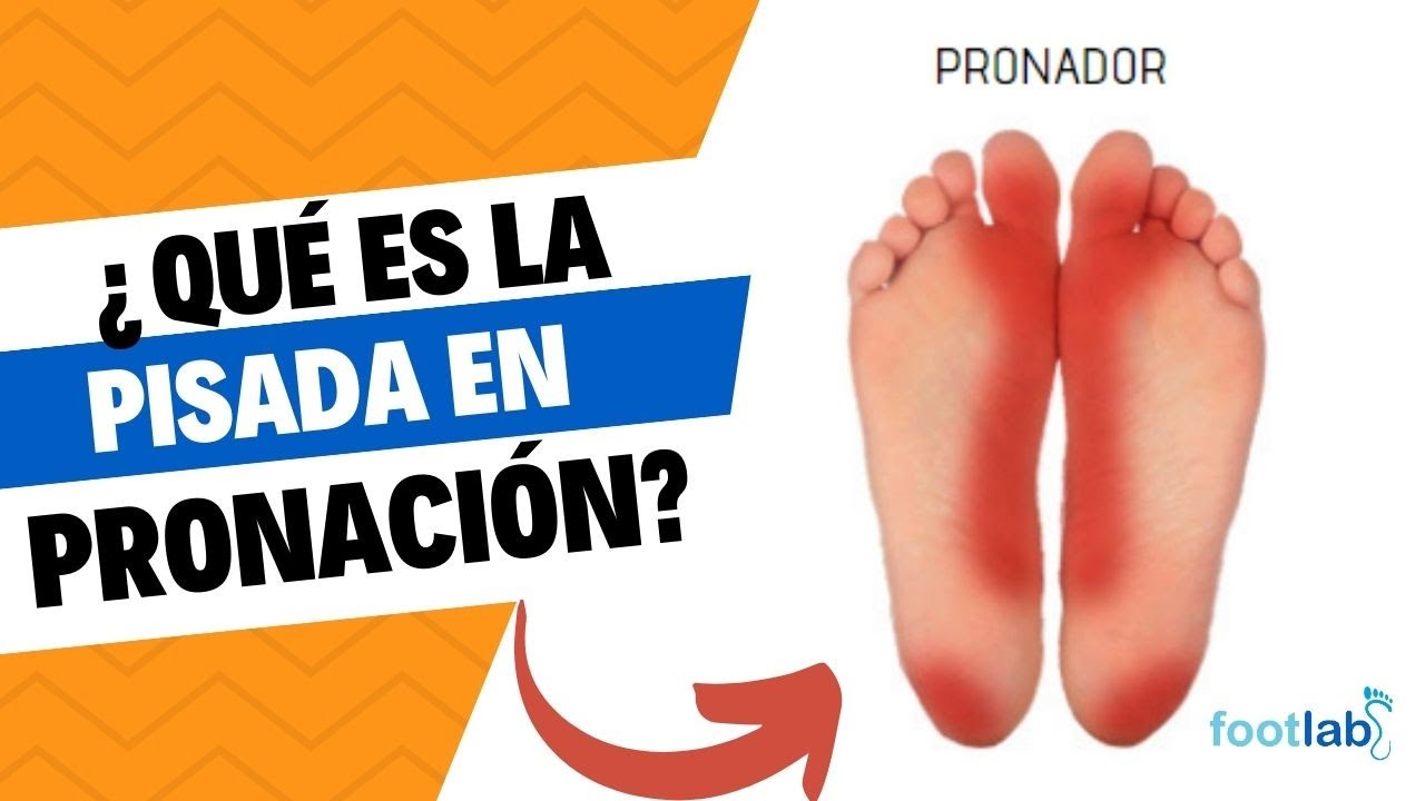 Clasificación y tratamientos de la pisada en pronación - YouTube