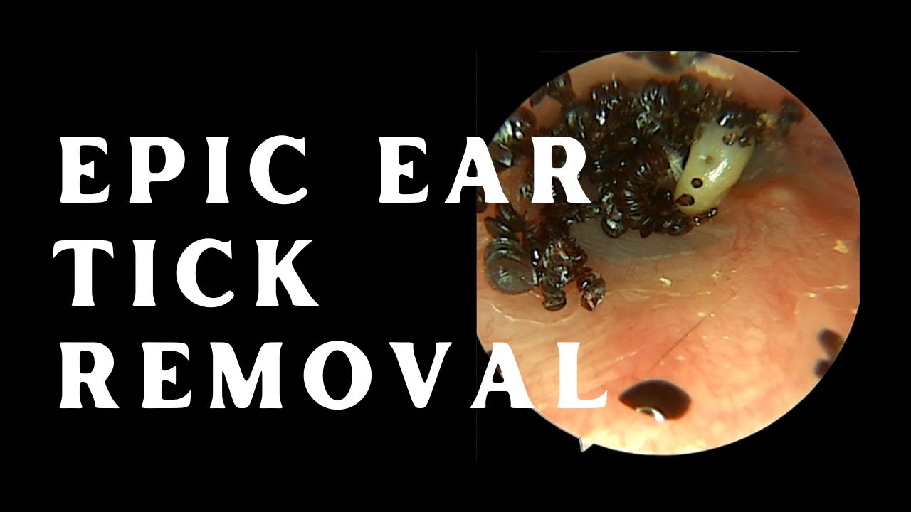 EPIC EAR TICK REMOVAL!!! MUST WATCH VIDEO BEFORE YOU DIE (4K 60fps ...