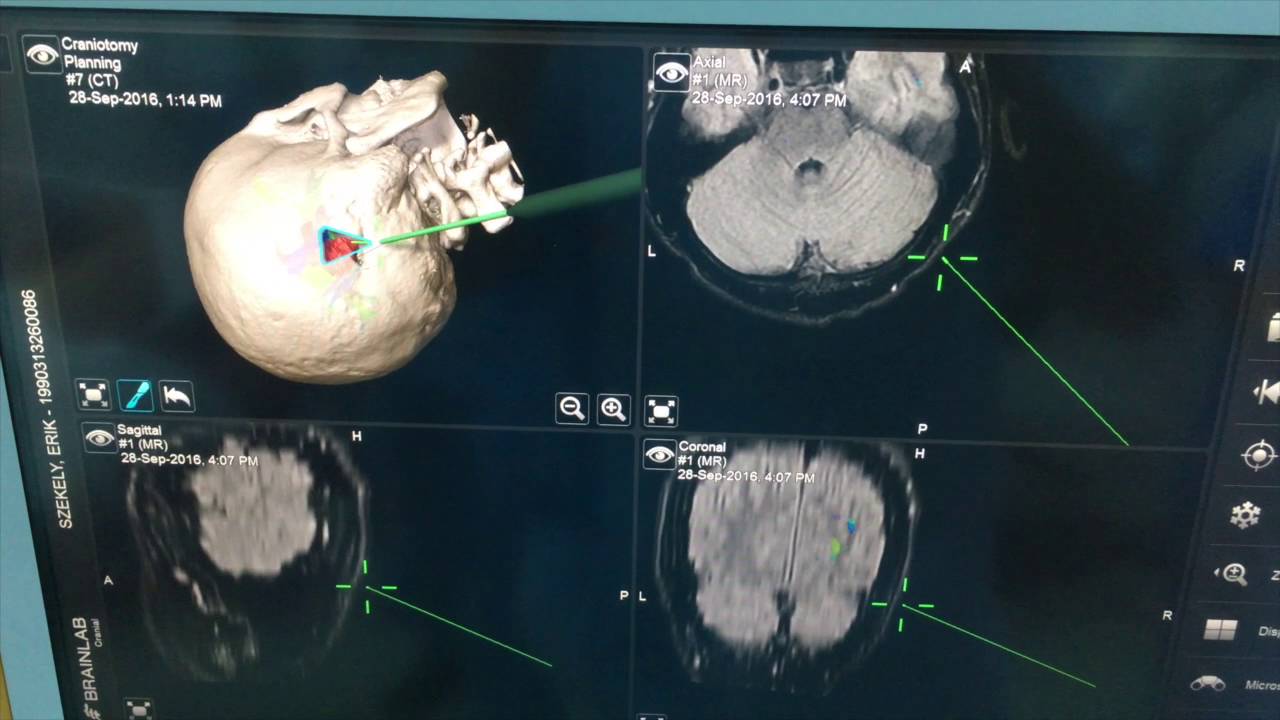 Targu Mures CaptiView and BrainLAB - YouTube