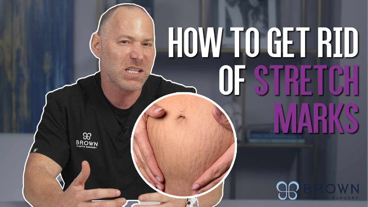 How To Get Rid Of Stretch Marks | Brown Plastic Surgery - YouTube