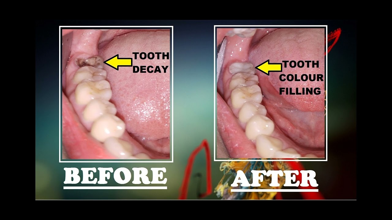 TOOTH FILLING OR RESTORATION OF DECAYED TOOTH - YouTube