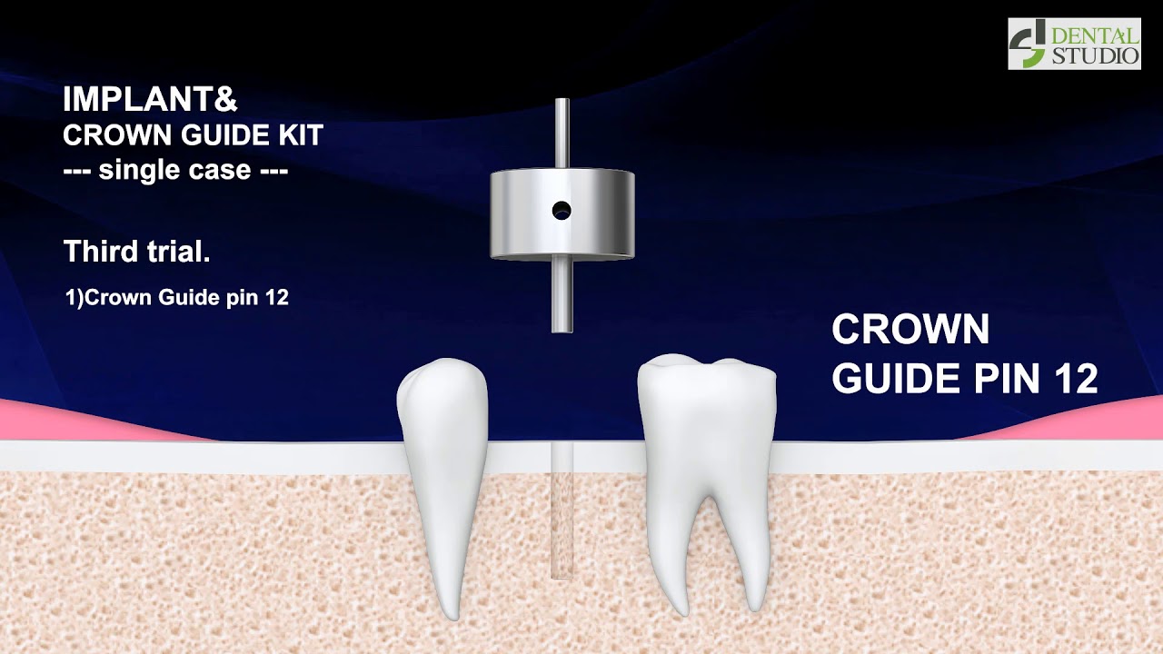 implant crown guide kit 2 - YouTube