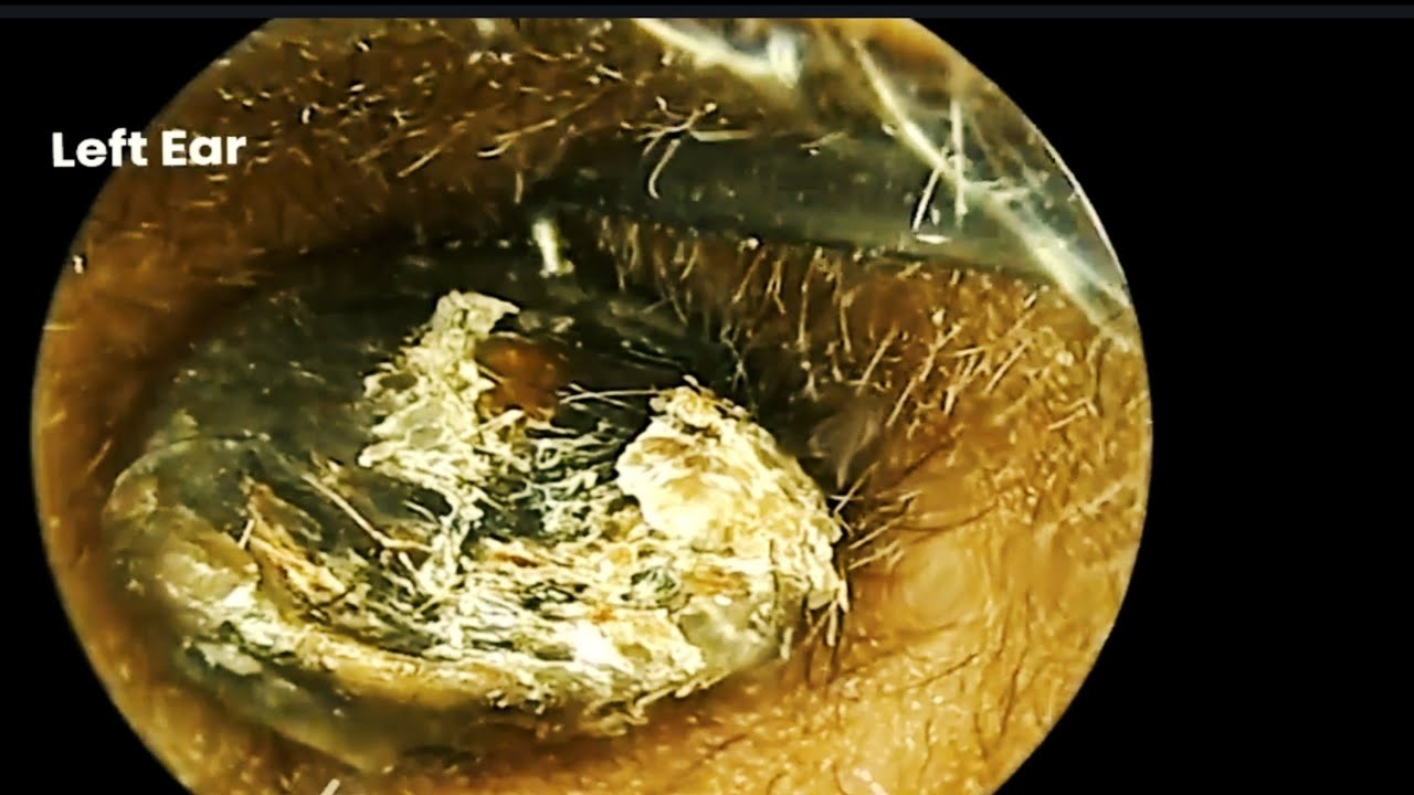 Ear Was Removal | ASMR Best And Safest Method To Remove Ear Wax - YouTube