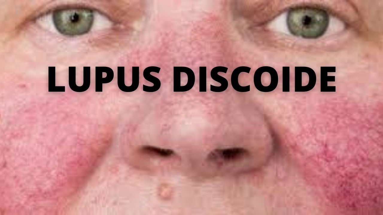 LUPUS DISCOIDE - YouTube