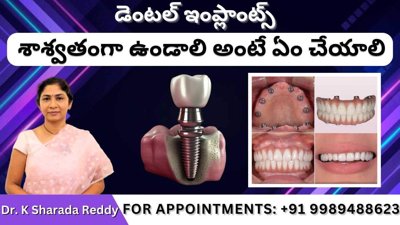 డెంటల్ ఇంప్లాంట్స్ శాశ్వతంగా ఉండాలి అంటే ఏం చేయాలి | by Dr. K Sharada ...