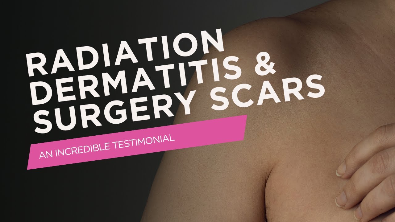 Radiation Dermatitis & Surgery Scars Improved | An Incredible ...