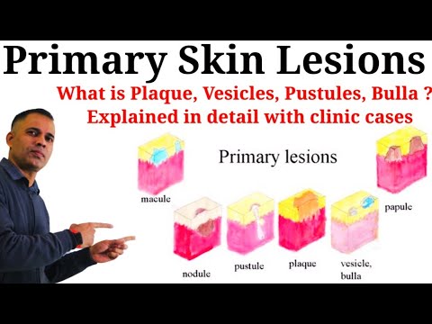 Primary Skin Lesions | Plaque, Vesicles, Pustules , Bulla | Dr.Dinesh ...
