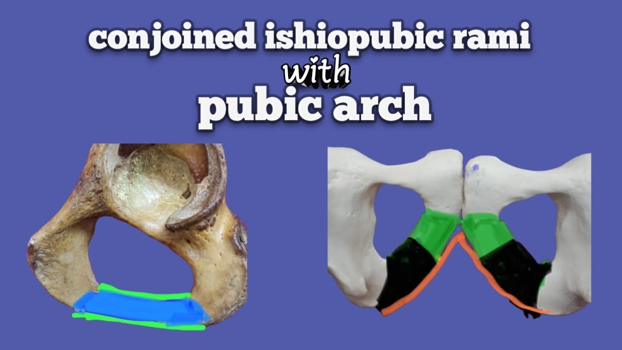 conjoined ishiopubic rami with pubic arch | lower limb of anatomy ...