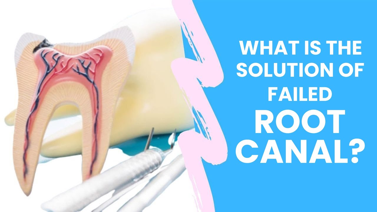 What is The Solution If Root Canal Treatment Fails? | Tooth Extraction ...