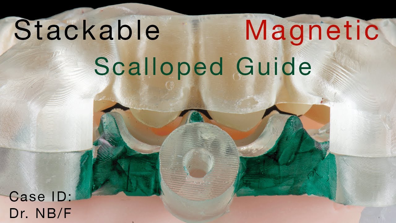 Stackable Guide 4 Natural Papilla in FP1 Prosthetics! - YouTube